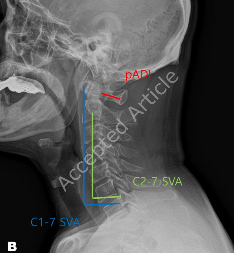 C1-2后路融合术后放射学参数与临床效果_江伟_副主任医师_爱问健康