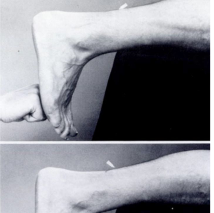 跟腱断裂的体格检查试验_罗轶_主任医师_爱问健康