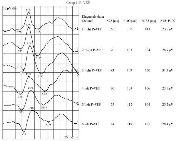 给大家科普一下图形视觉诱发电位（P-VEP）_汤锡强_主治医师_爱问健康